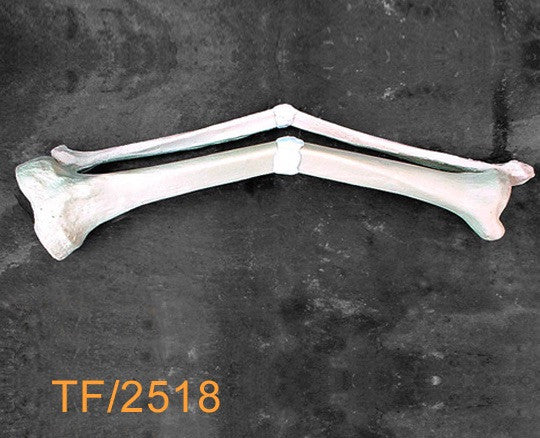 Tibia & Fibula Large Left with mid-shaft malunion / Varus deformity TF ...